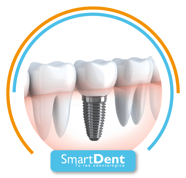 PROMO IMPLANTES - 12 cuotas - Smart Salud